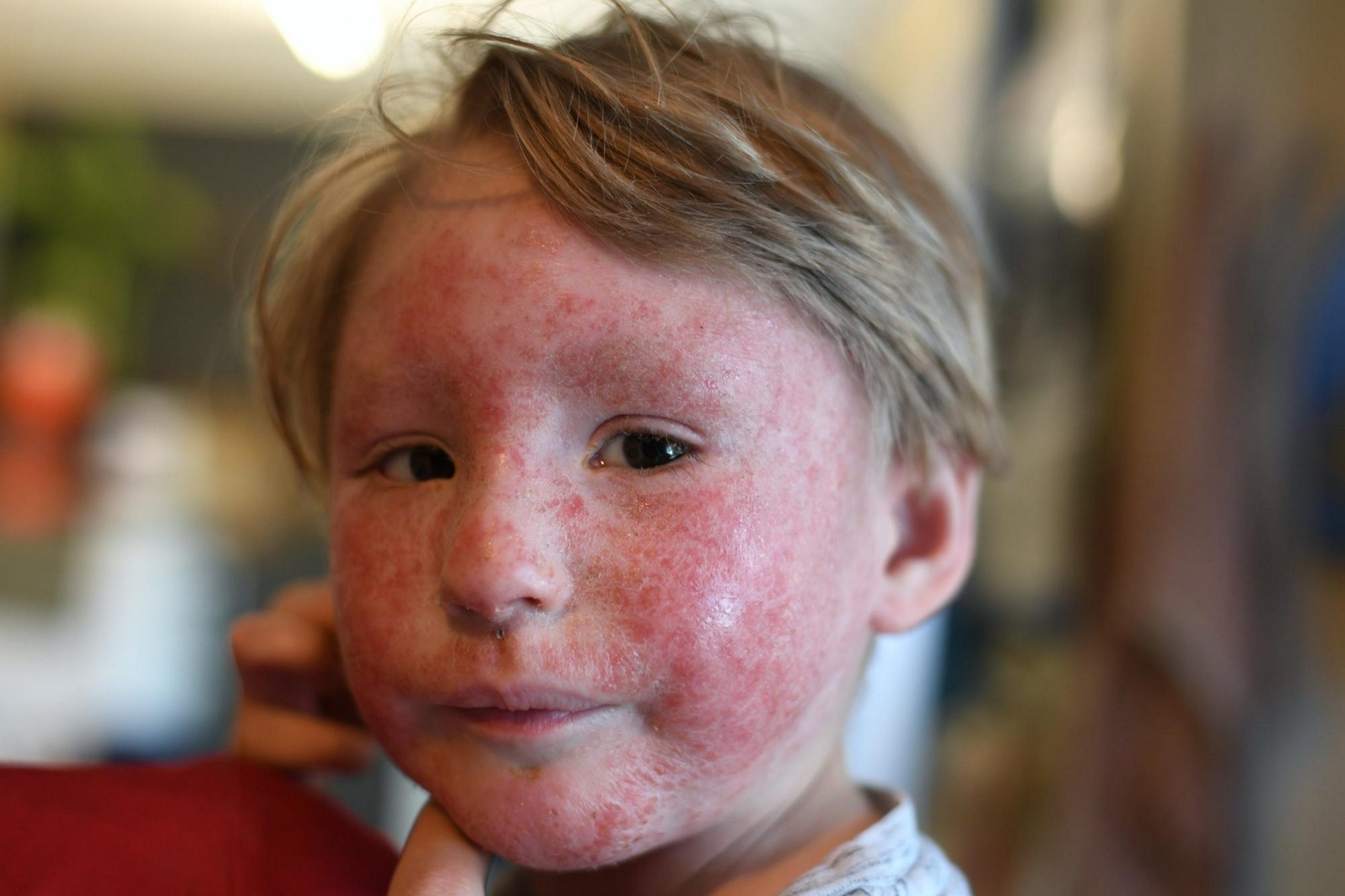 Toddler overcomes severe eczema after new treatment