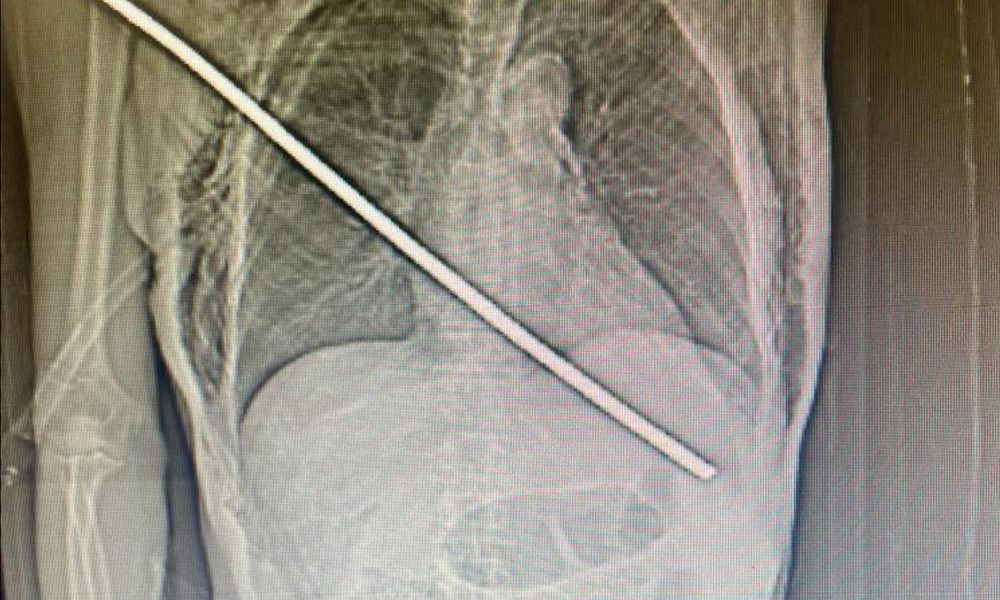 Man survives falling on iron rod that pierced his heart and lungs